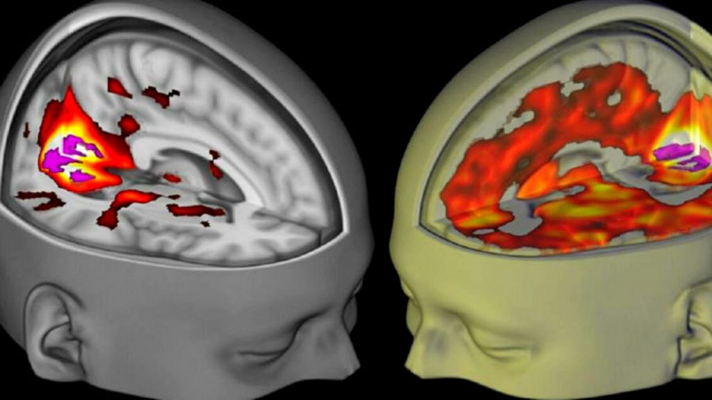 La imagen del cerebro bajo los efectos del LSD por la que los científicos esperaron 50 años ...