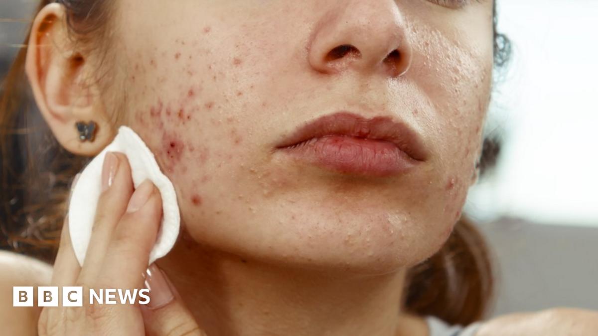 Can high street acne treatments really get rid of your spots? - BBC News