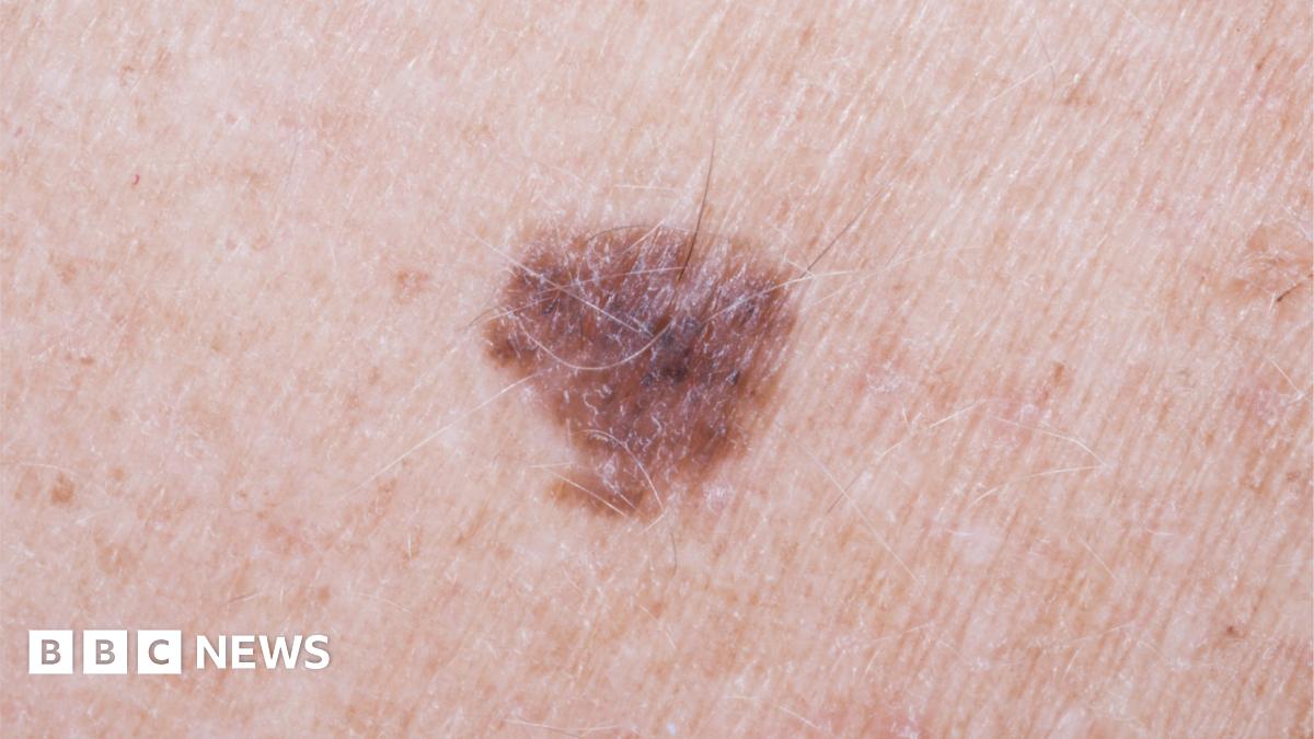 Arm mole count 'predicts skin cancer risk' - BBC News