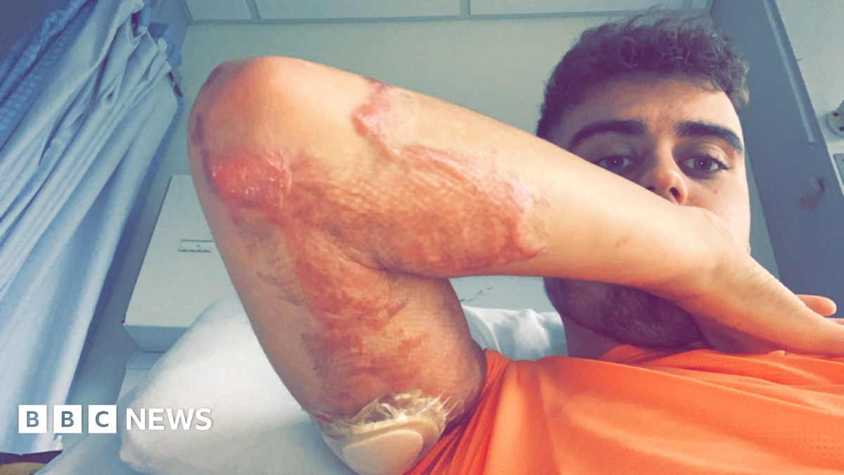 Man buried in concrete left with life-changing injuries - BBC News