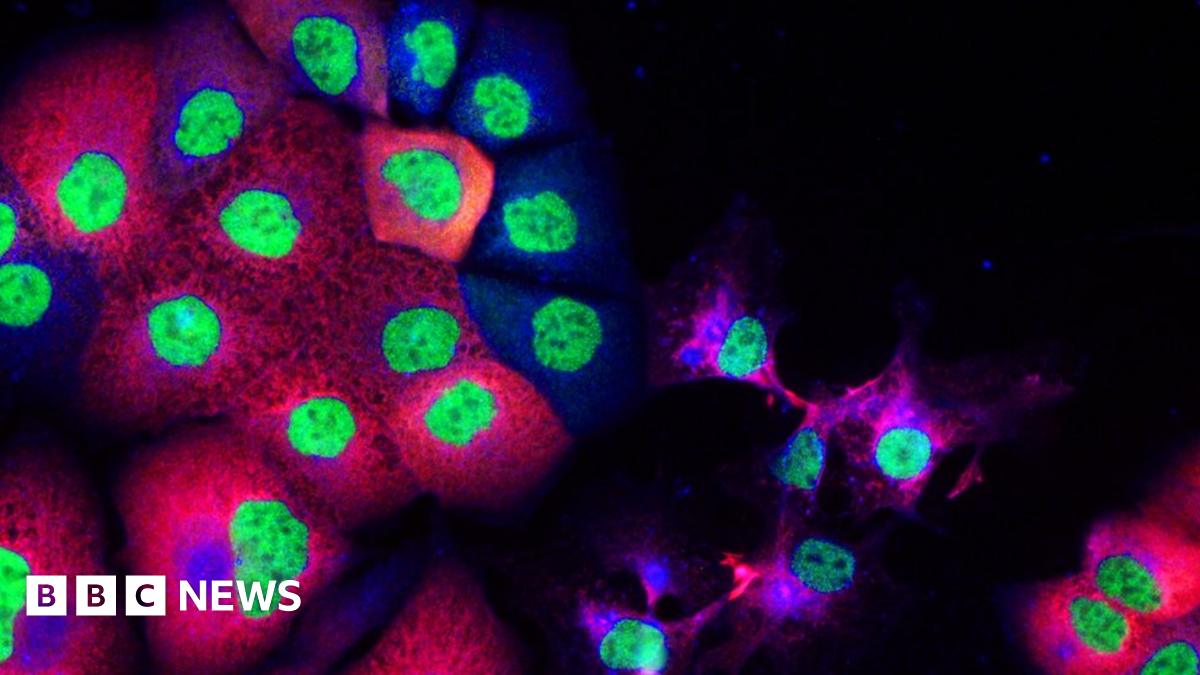 Prostate cancer blood test 'helps target treatment' - BBC News