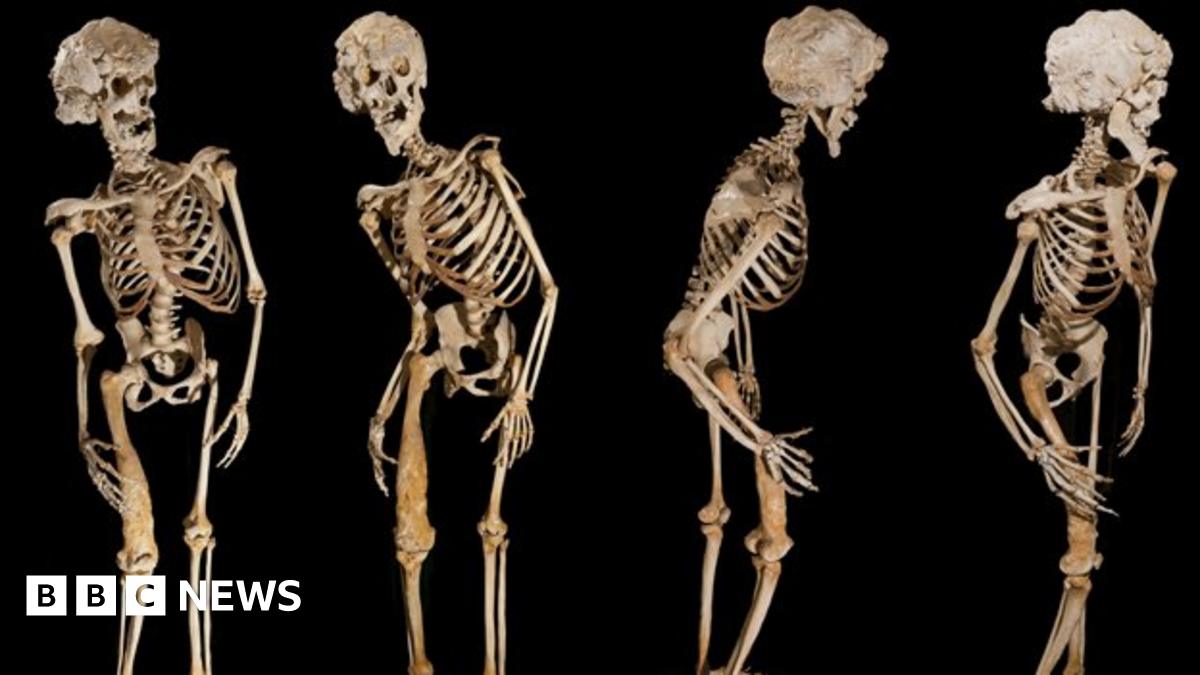 Unlocking the secrets of the Elephant Man - BBC News