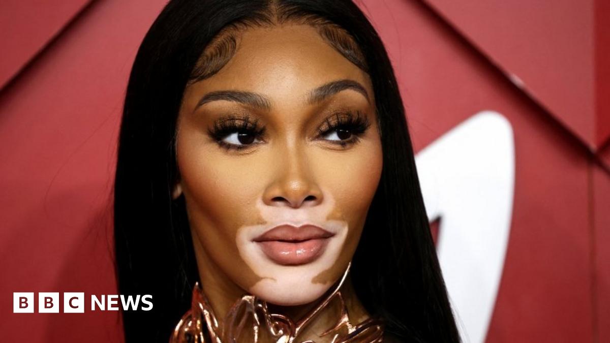 Vitiligo: Controversial skin cream may come to UK - BBC News