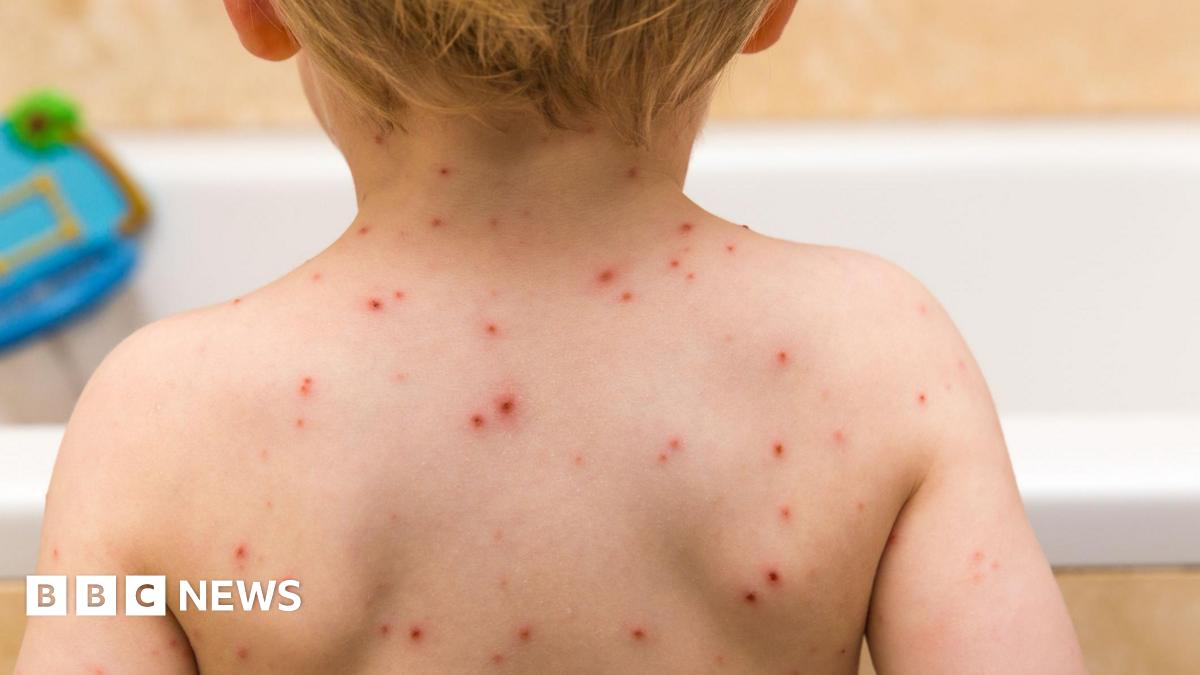 Children offered chickenpox vaccine on NHS - BBC News