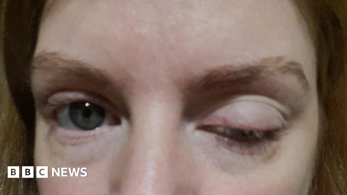Botox 'left Northumberland woman unable to open eye for 16 weeks' - BBC ...