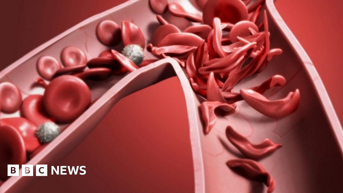 Sickle cell disease: Nurses need better training, says health union ...