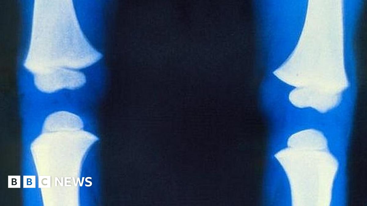 Borders pharmaceuticals firm seeks rickets drug authorisation - BBC News