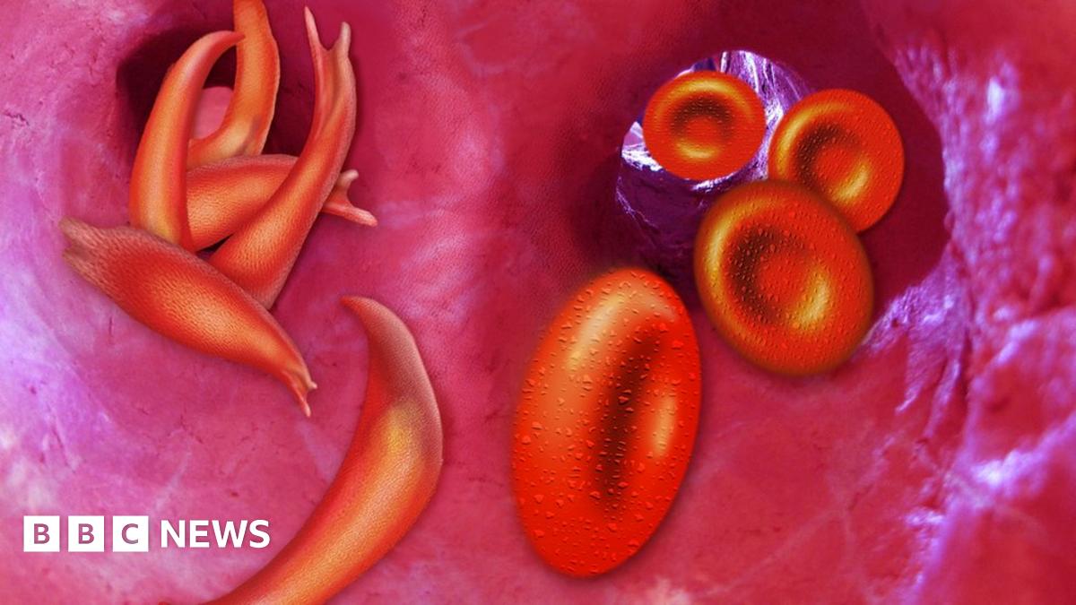 Tracing sickle cell back to one child, 7,300 years ago - BBC News
