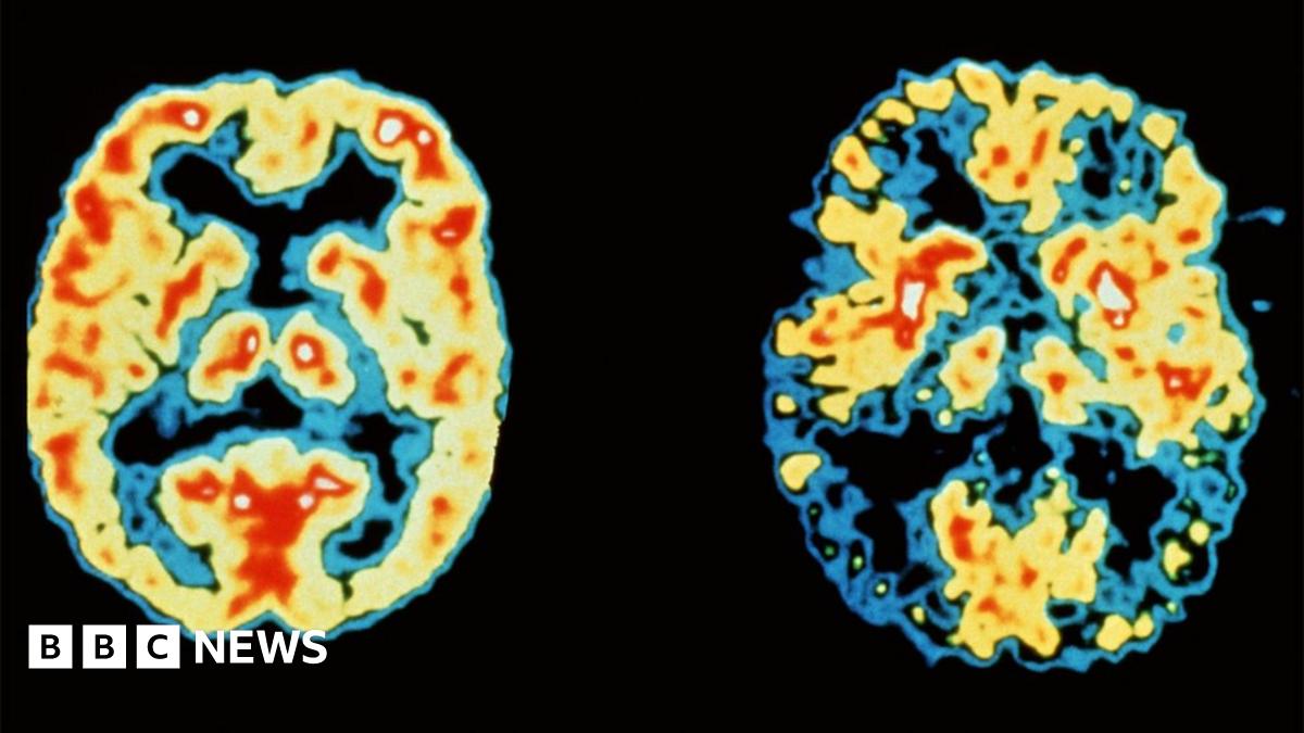 Dementia now leading cause of death - BBC News