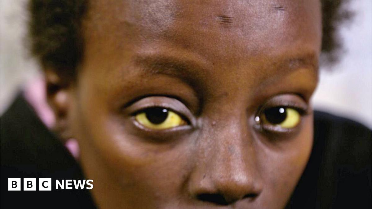 Kenya sickle cell: Fighting to dispel the myths around the disease ...