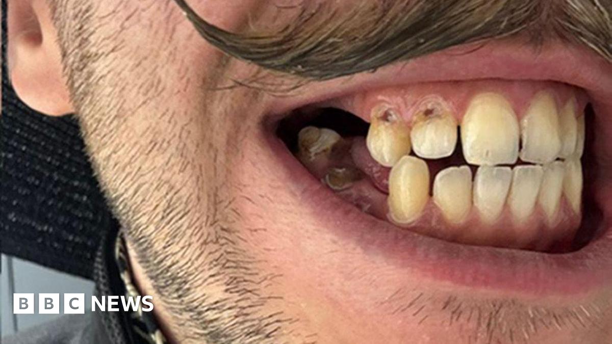 Man with dentist phobia sees teeth 'crumble away' - BBC News