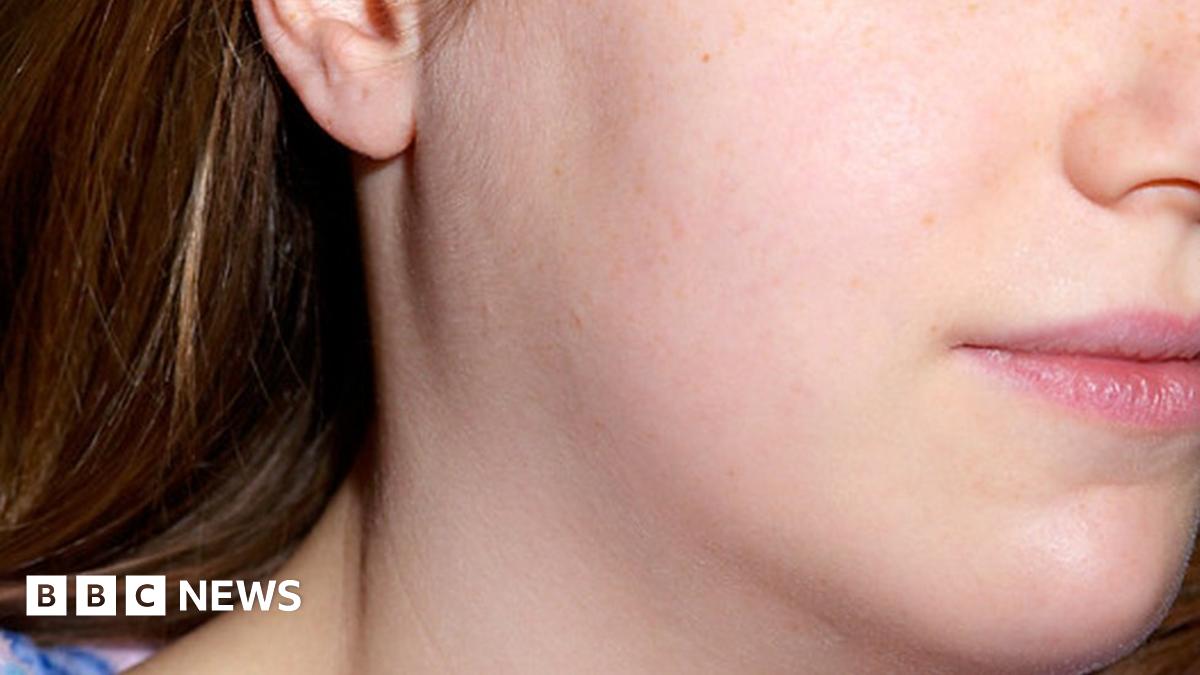 Mumps: Northern Ireland cases 700% rise down to vaccine cycle - BBC News