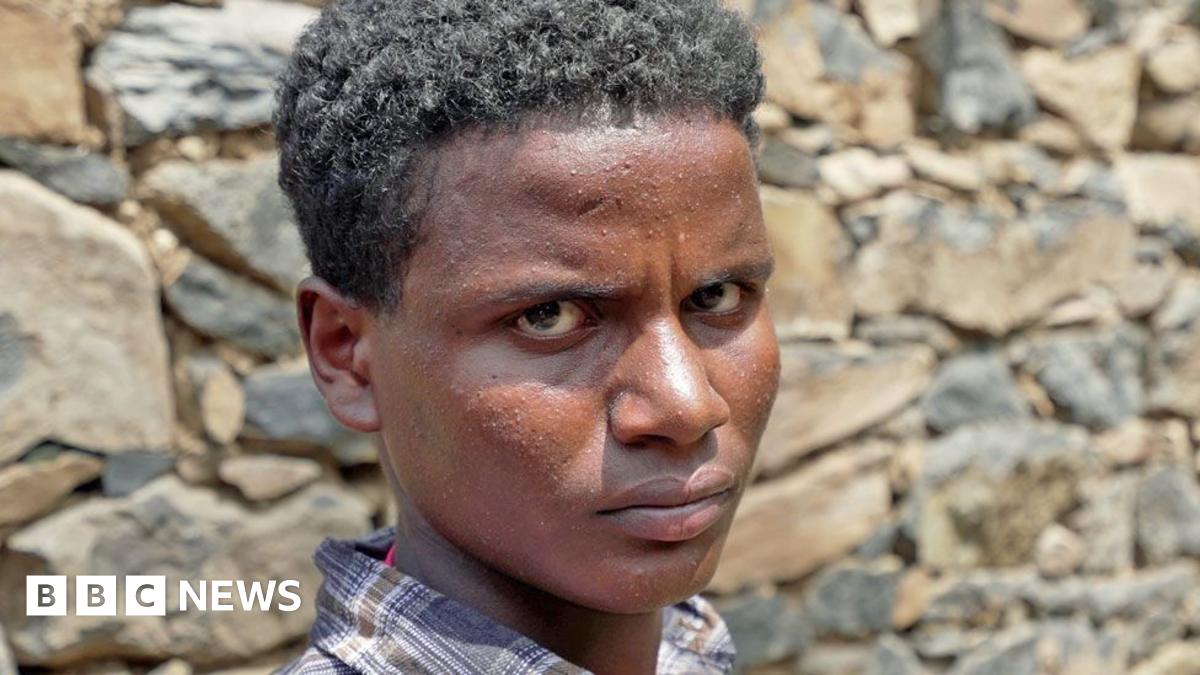 Ethiopia's Tigray truce: 'I lost my leg on the way home from school ...