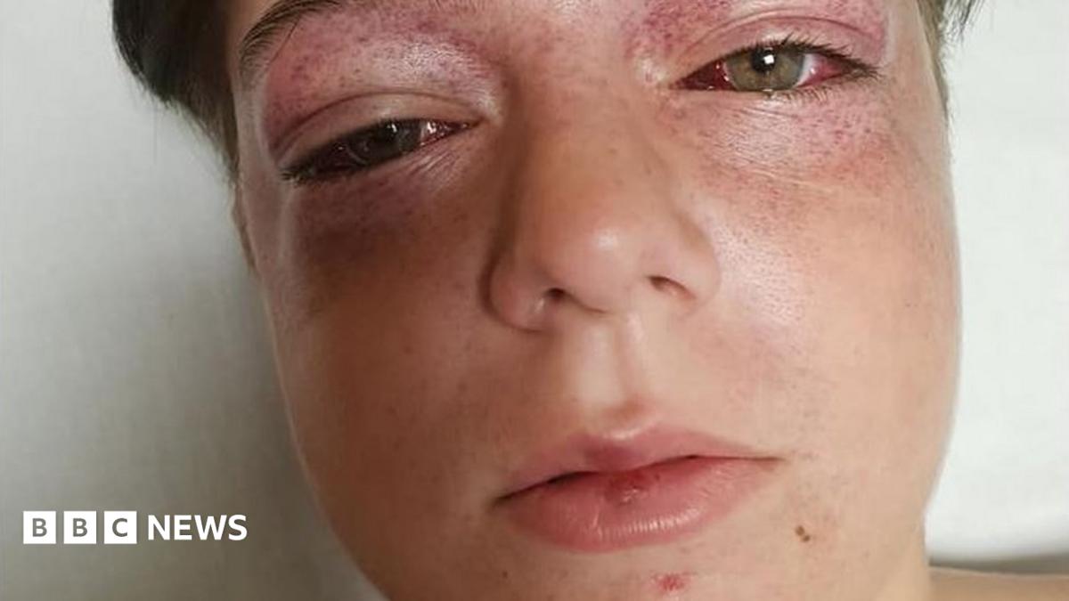 Boy hurt in 'stupid' YouTube roundabout stunt attempt - BBC News