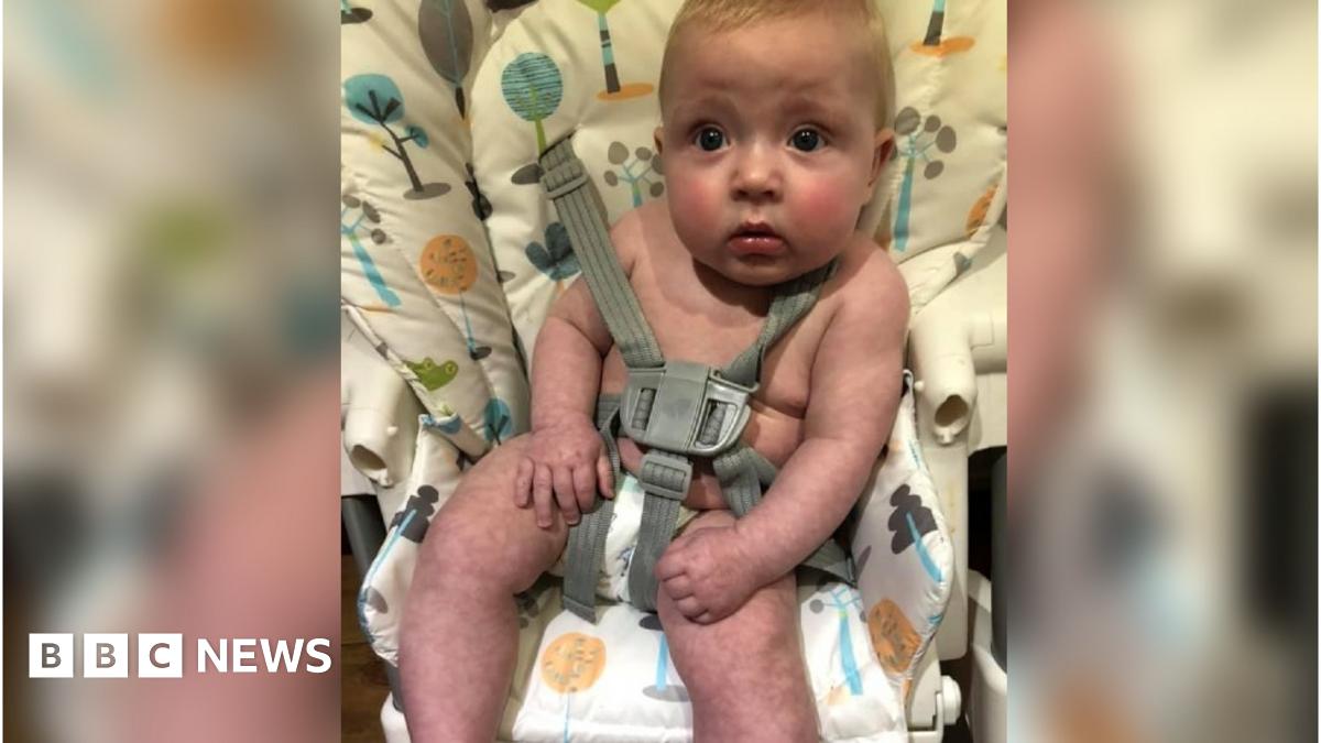 Covid-19: Baby's mother issues mottled skin warning - BBC News