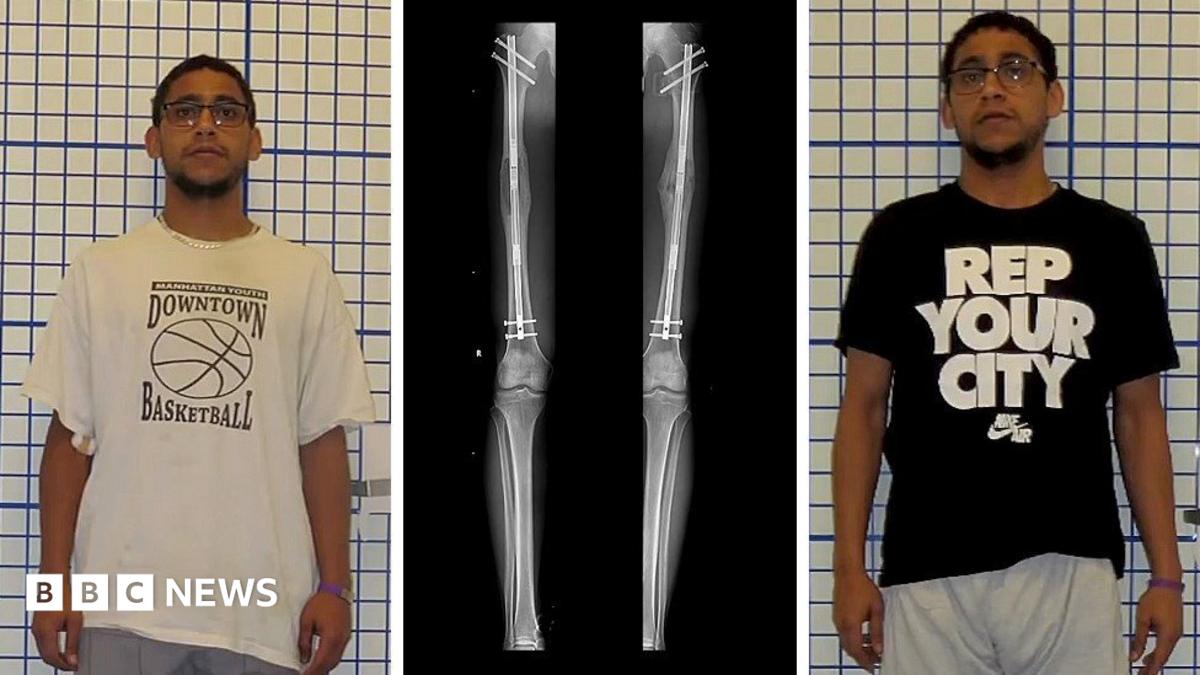 Leg-lengthening: The people having surgery to be a bit taller - BBC News