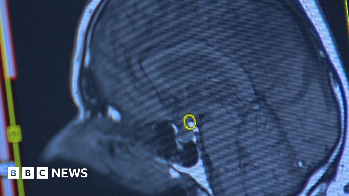 Scottish researchers find 100 genes linked to depression - BBC News