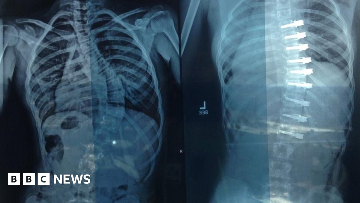 Scottish surgeons want twisted spine operation approval - BBC News