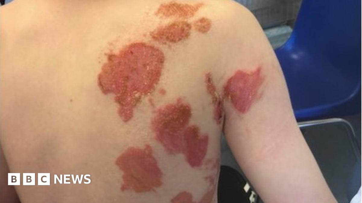 Safety alert after school pupils burned by exploding kettle - BBC News