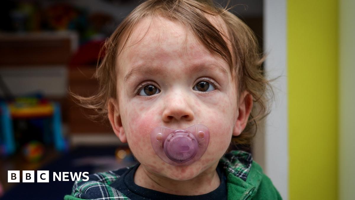 London measles warning: Outbreak could hit tens of thousands - BBC News