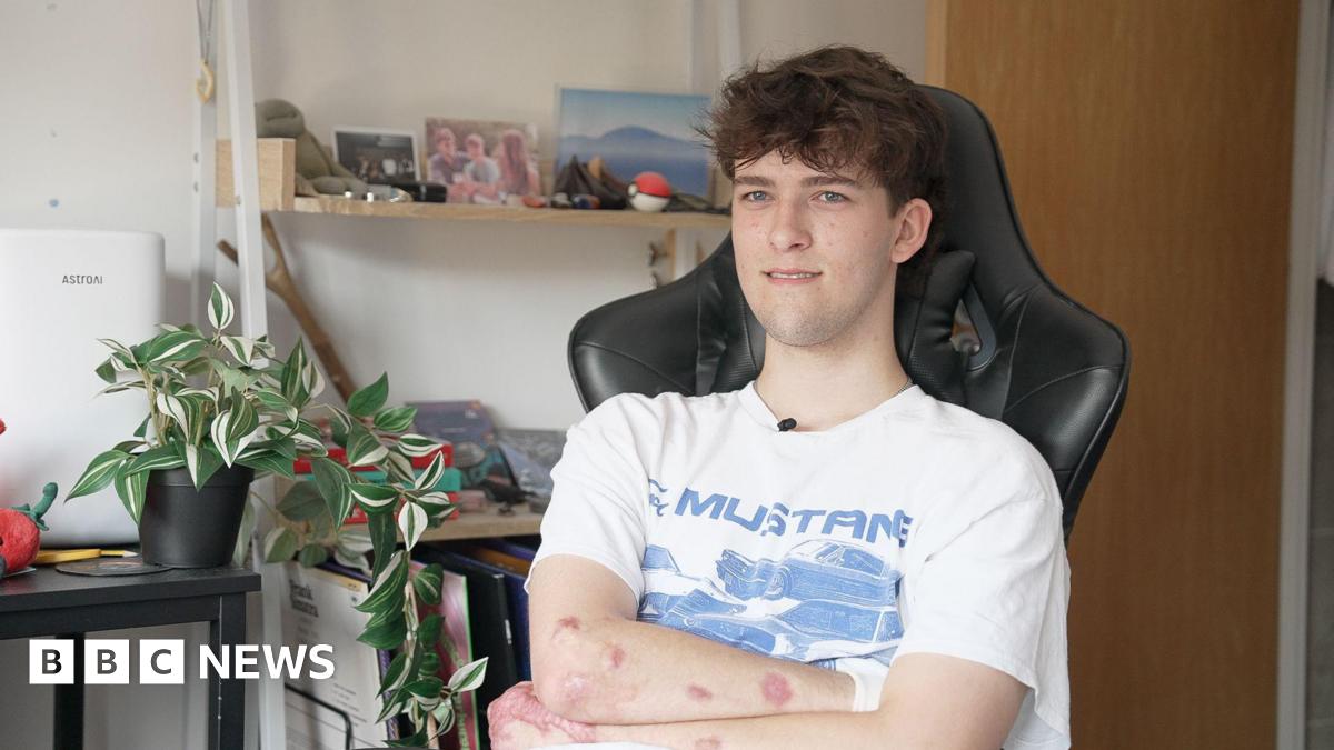 Sepsis: Teen Hamish Wilson 'rebuilding his life' after surgery - BBC News