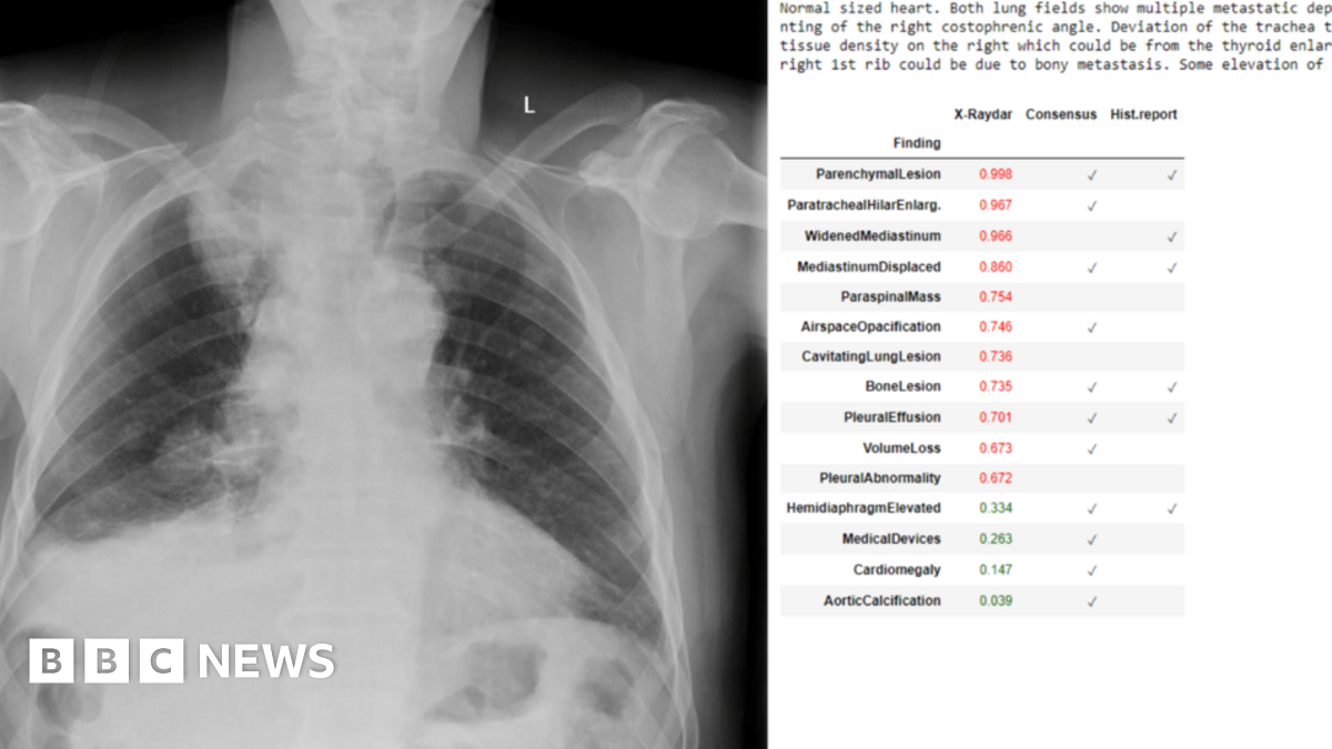 AI as good as doctors at checking X-rays - Warwick University - BBC News