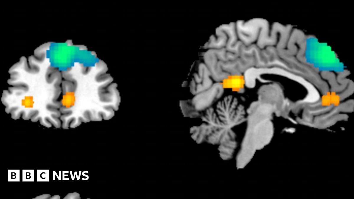 Essex University's AI brain study brings 'hope' to childhood trauma ...