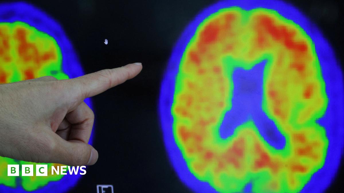 Alzheimer's and dementia mortality at highest level since 2000 - BBC News