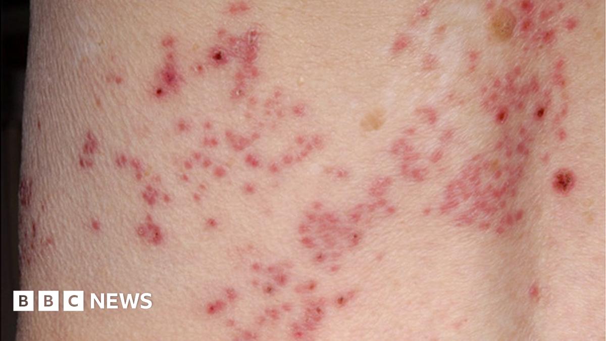 Shingles vaccine 'has cut cases by a third' in England - BBC News