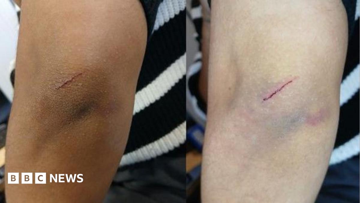 Met Police: Tool used to help see bruises on those with dark skin - BBC ...