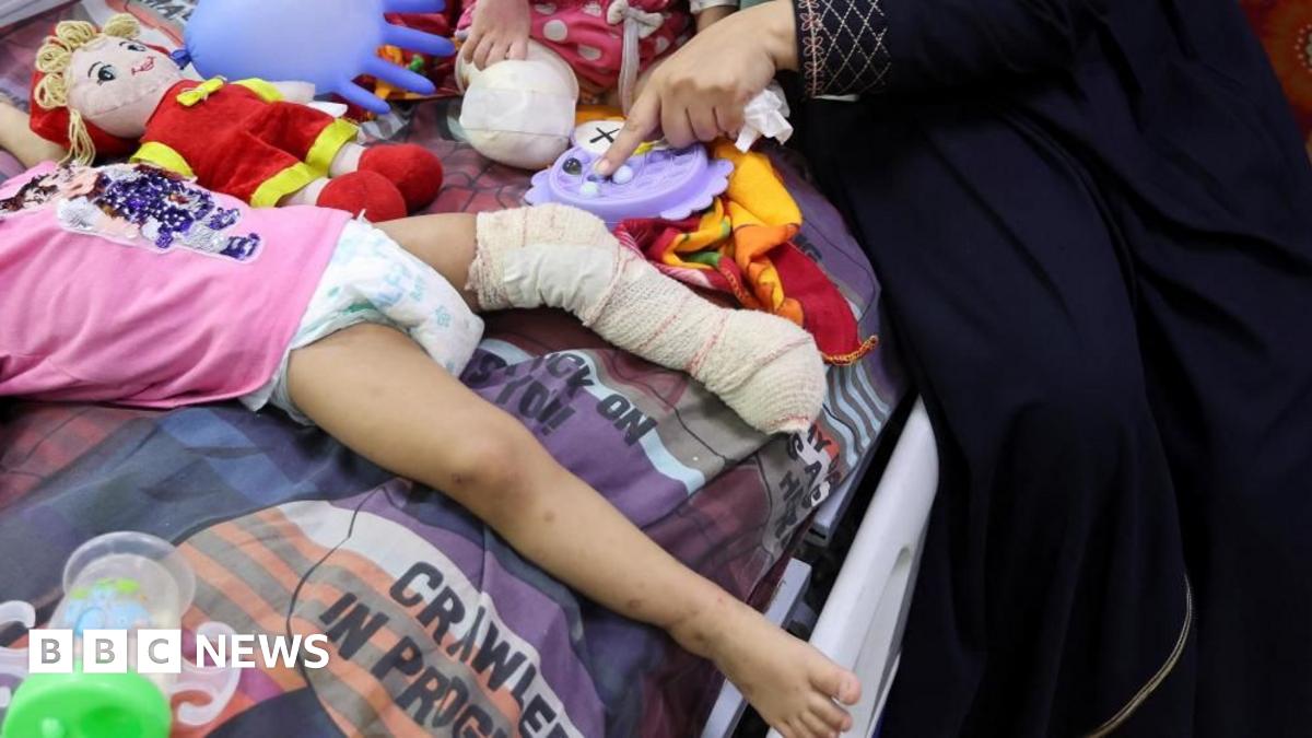 Plymouth ex-surgeon aims to help Gaza child amputees - BBC News