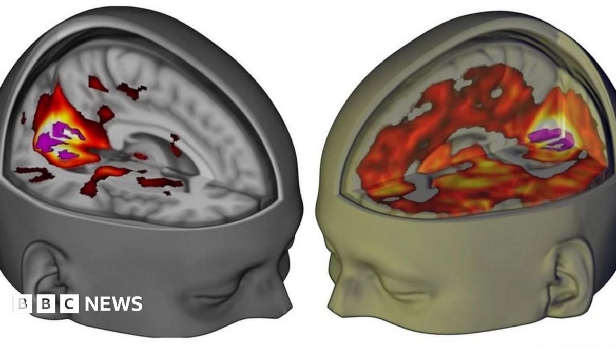 What LSD does to your brain - BBC News