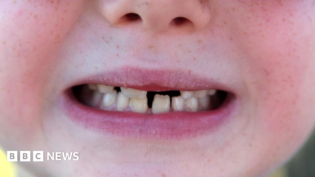 Blackpool mum removed six-year-old child's teeth with pliers - MP - BBC ...