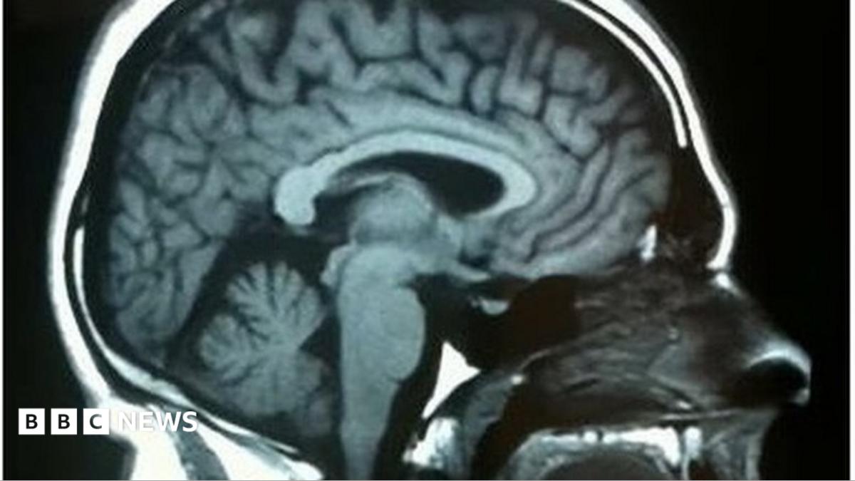 Alcohol-related brain damage at 10-year high - BBC News