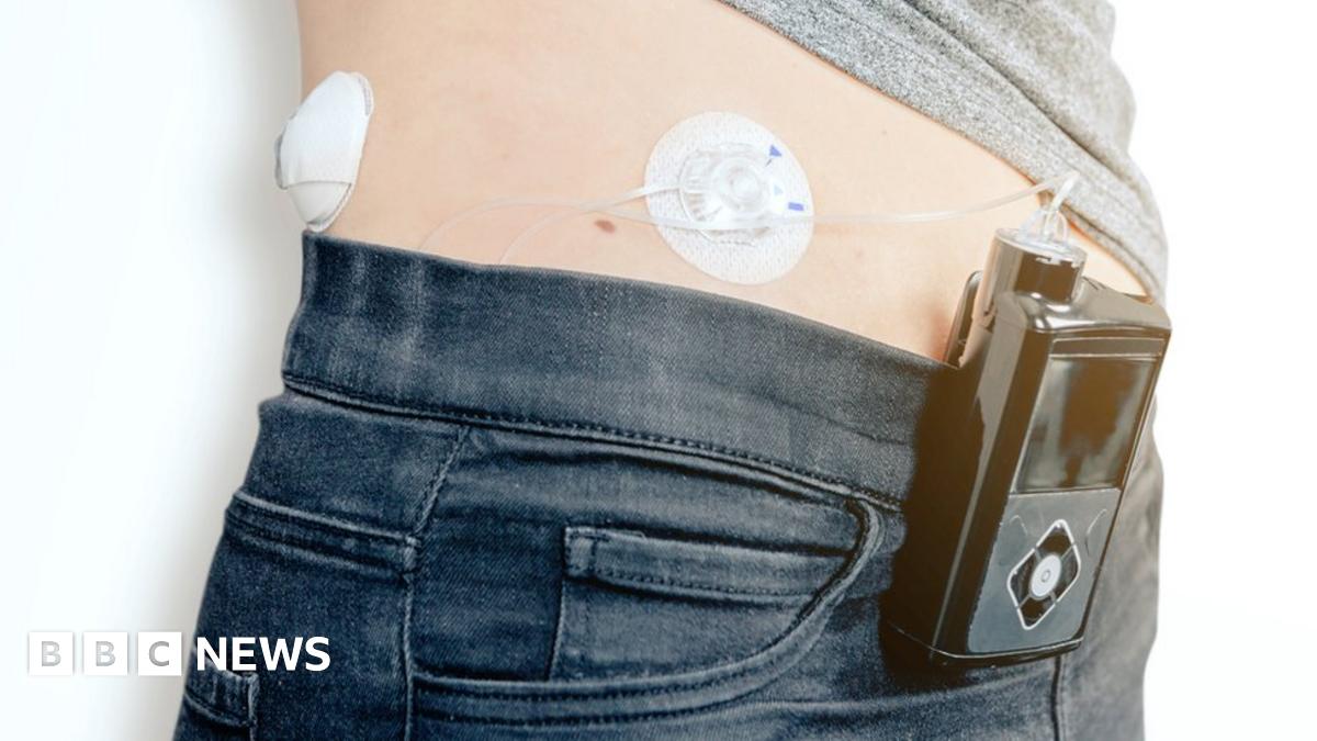 Diabetes patients to be offered artificial-pancreas technology - BBC News