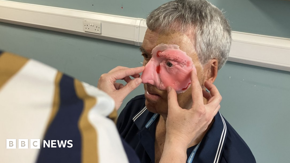 Cyclist get 3D printed face after bike accident - BBC News