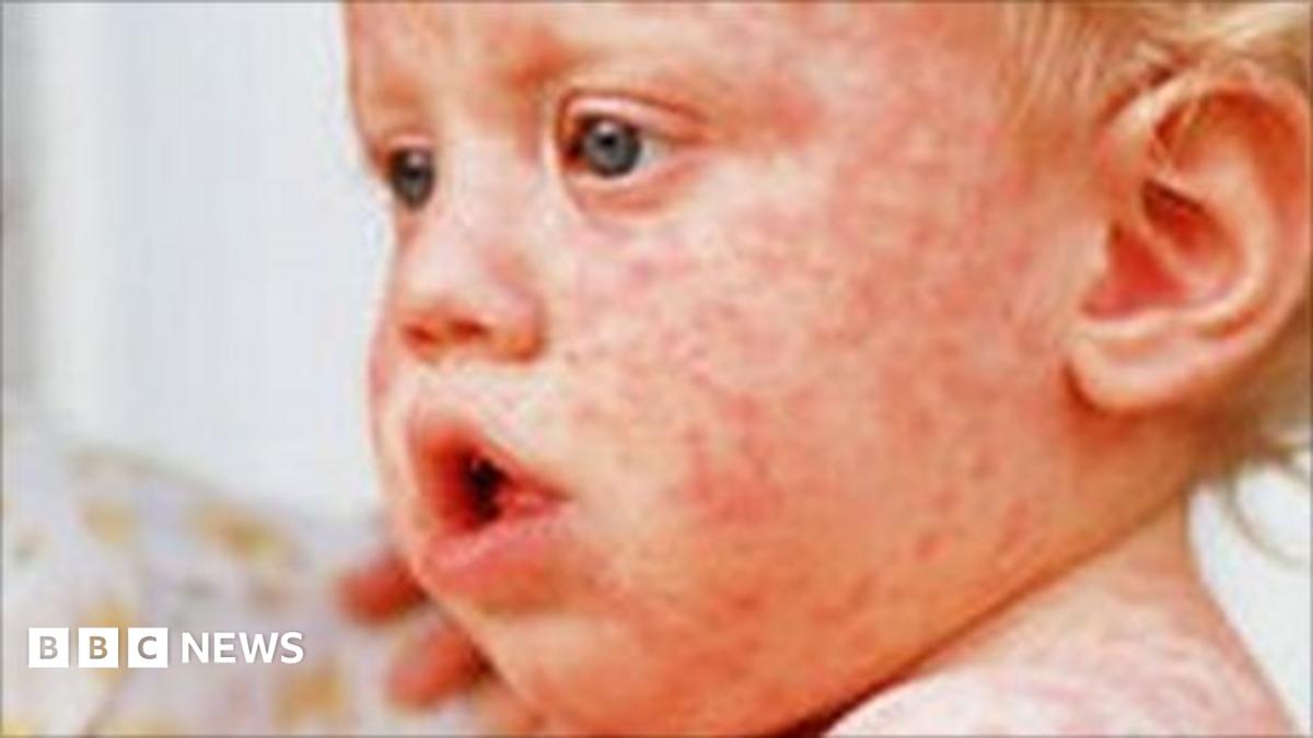 MMR vaccine rate increase prompts measles warning - BBC News