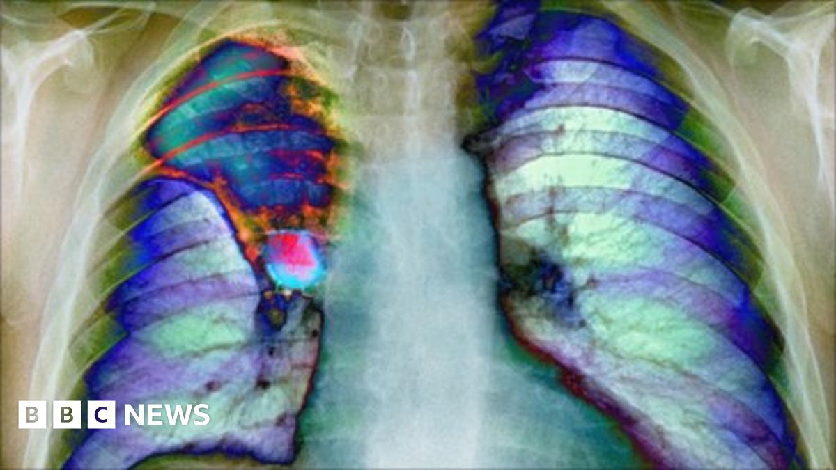 Liverpool 'has highest lung cancer death rate' - BBC News