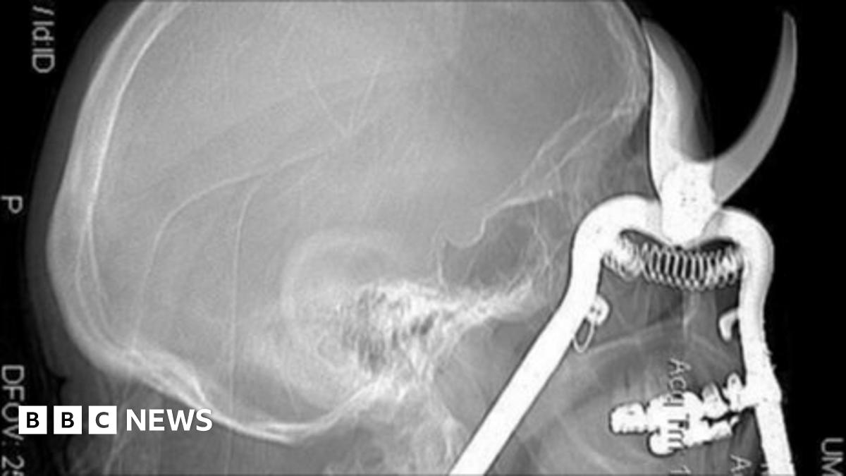 US gardener survives being impaled in eye with shears - BBC News