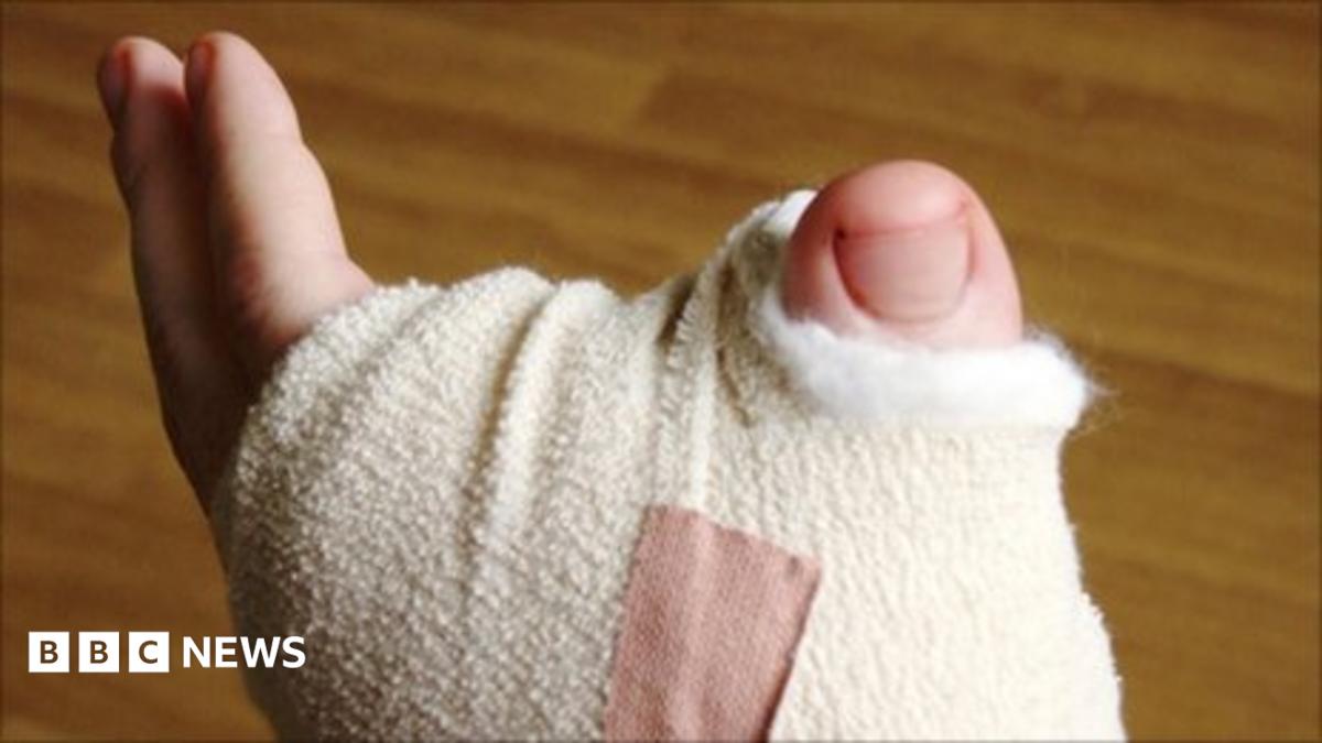 Man who severed thumb has big toe attached in its place - BBC News