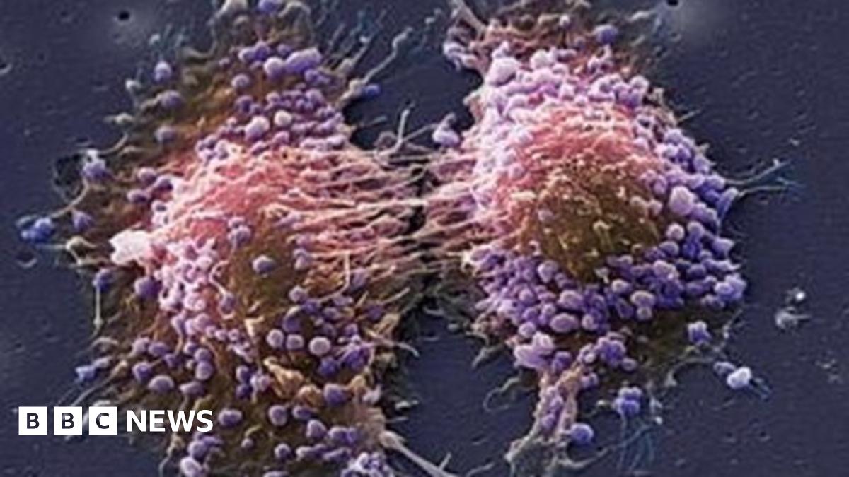 New prostate cancer treatment may reduce side-effects - BBC News