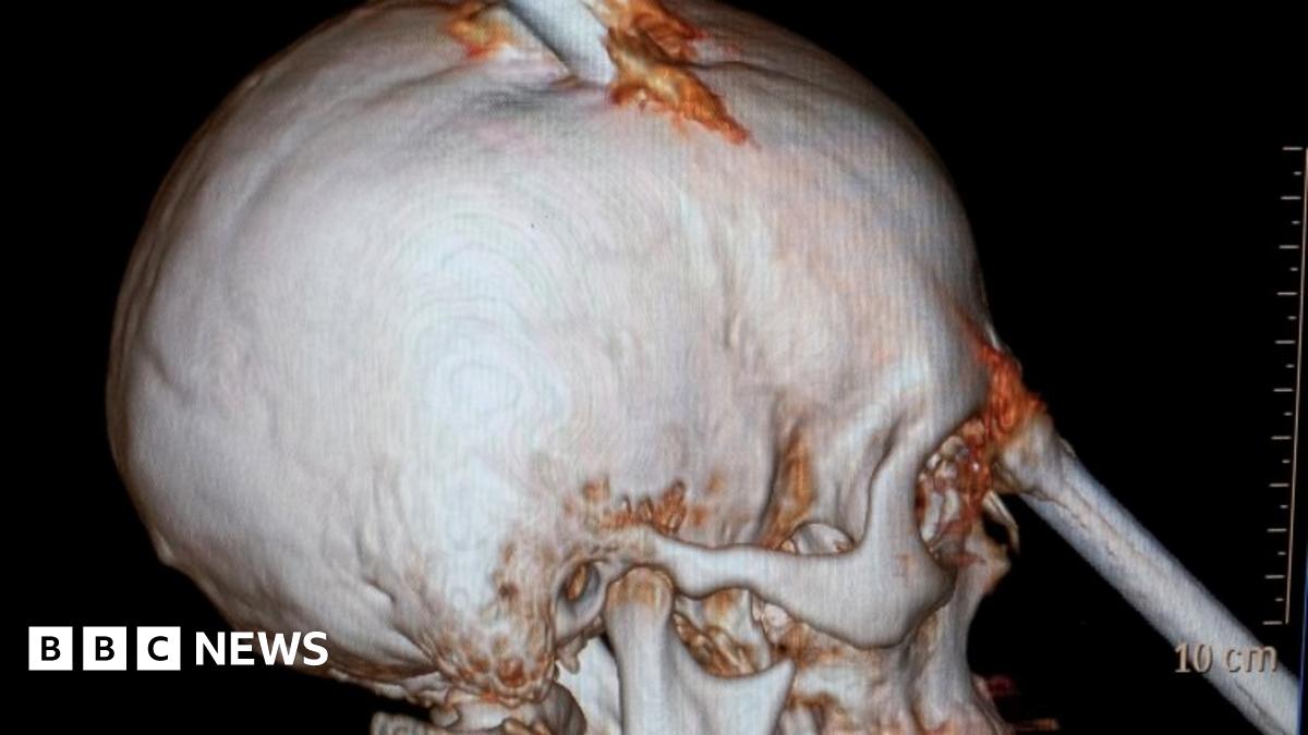 Brazil man survives steel rod through head - BBC News