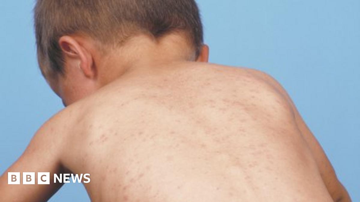 Measles rise: MMR jab take up targets not hit in Wales - BBC News