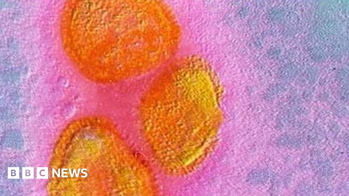 Mumps cases see 'dramatic rise' in Isle of Man - BBC News