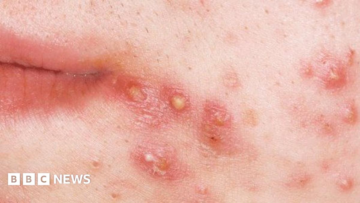 'Harmless skin virus' fights acne - BBC News