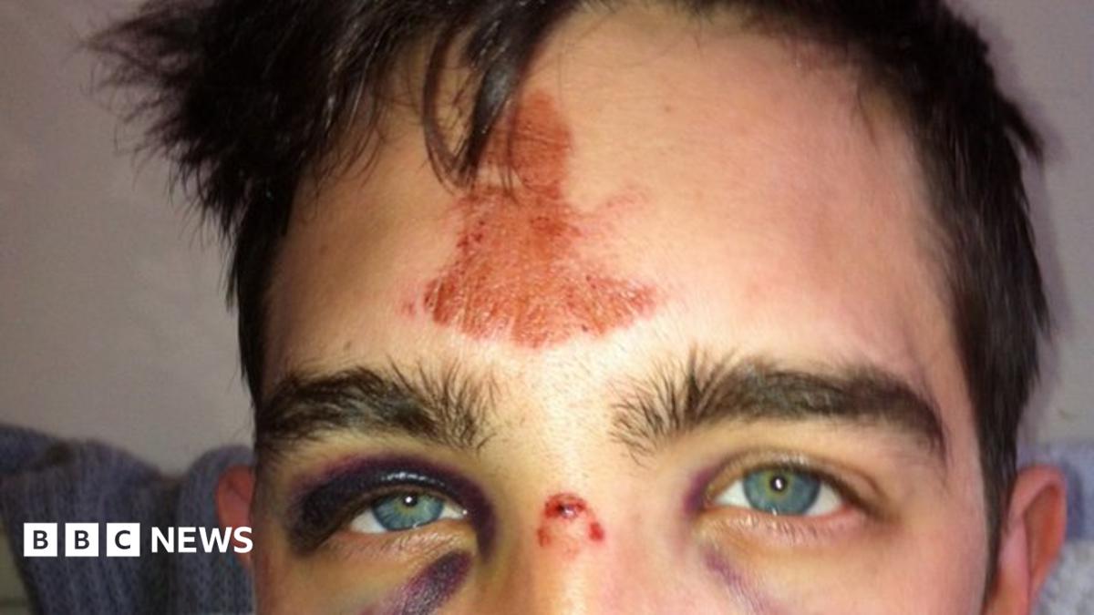 Man's skull smashed in 'English accent' attack claim - BBC News