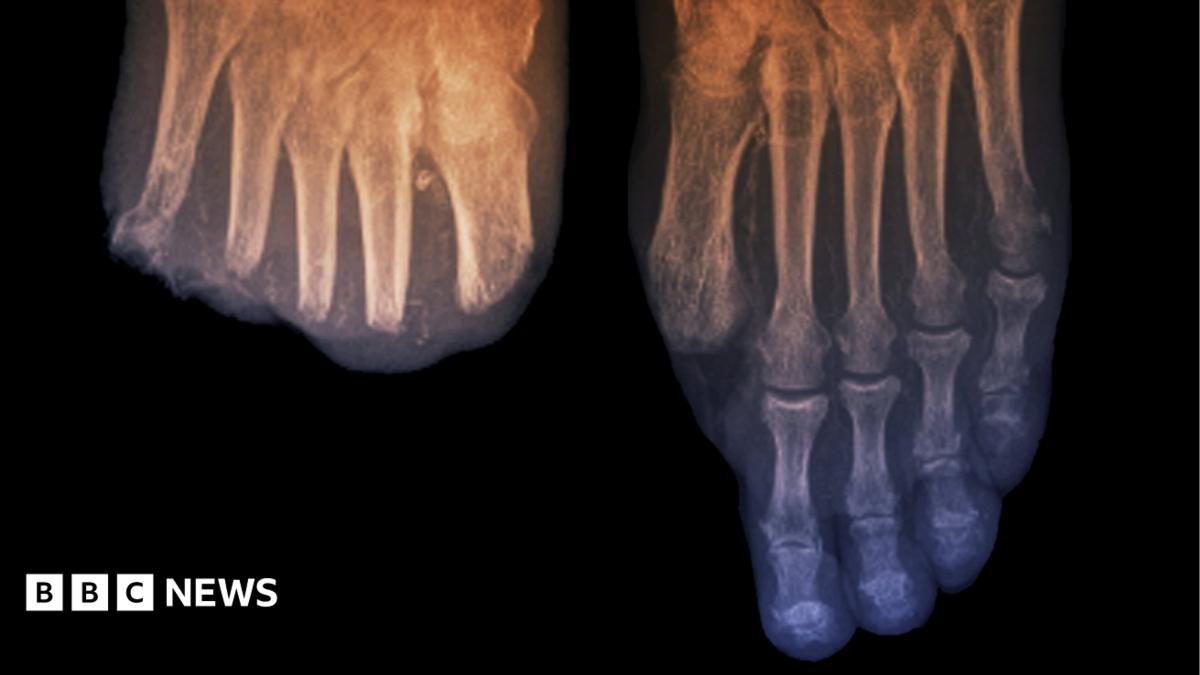 Slow care leads to foot amputations - BBC News