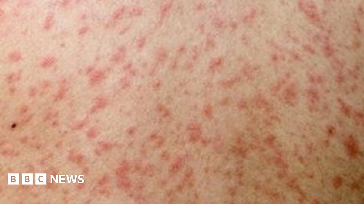 Measles: 64 new cases in south west Wales outbreak - BBC News