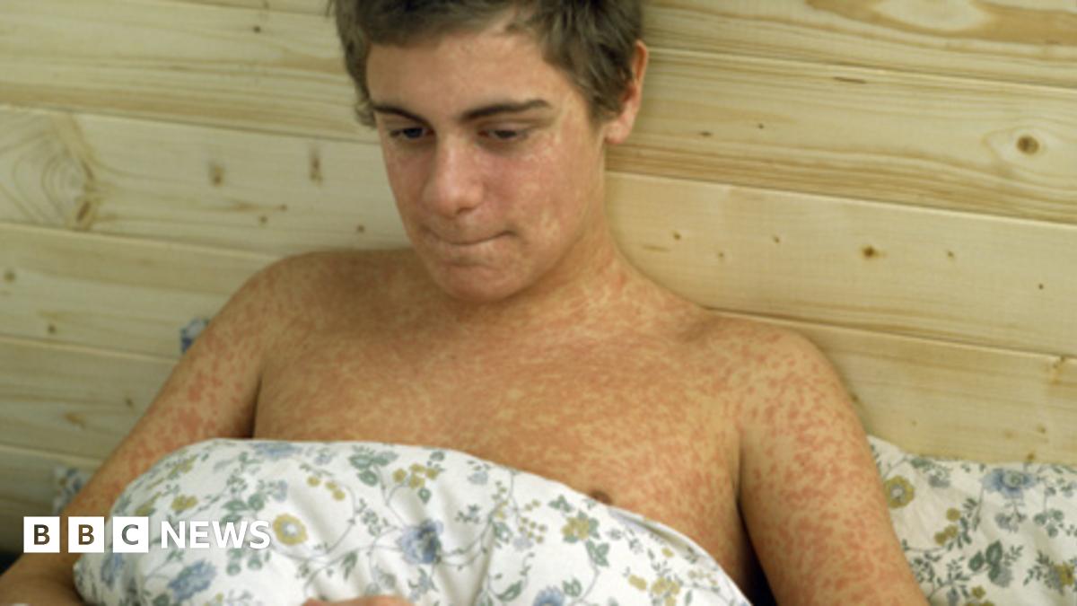 Newsbeat's guide to... Measles - BBC News