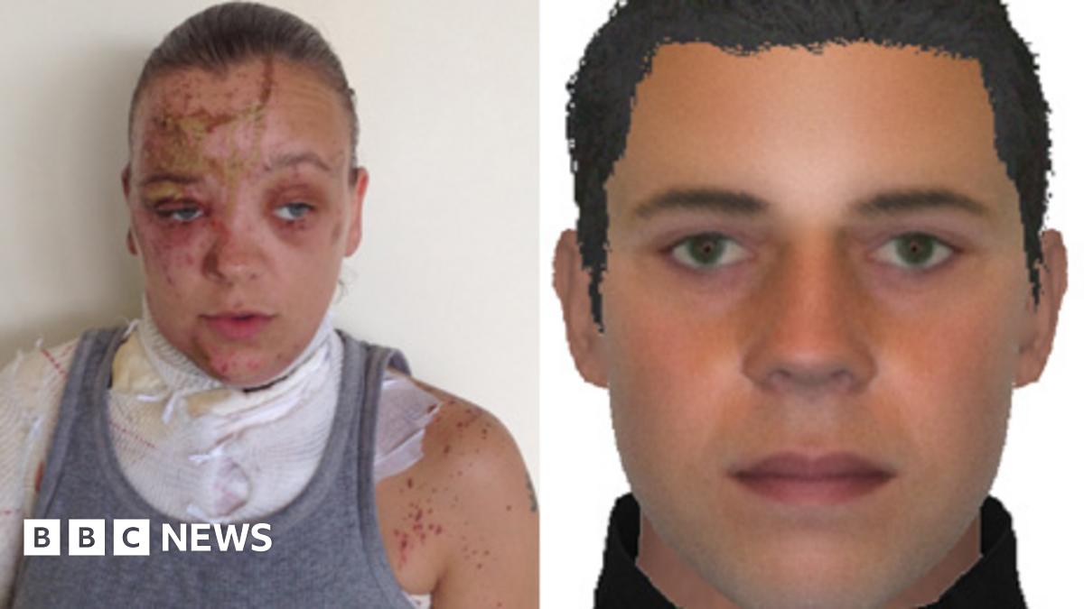 Romford acid attack victim photo released - BBC News